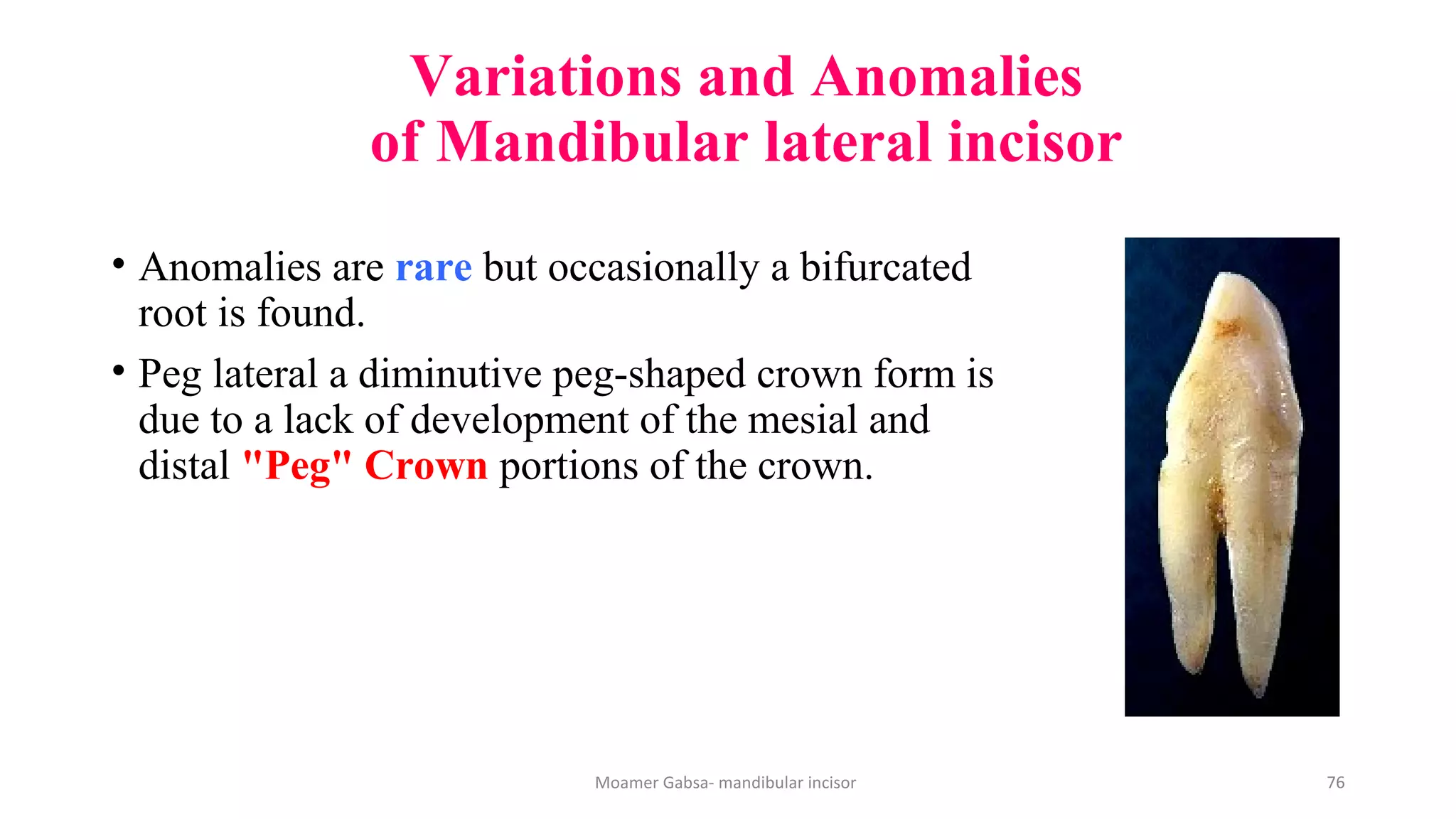 Morphology of mandibular incisors | PPT