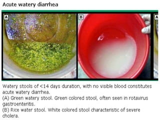 L 5. approach to diarhea | PPT