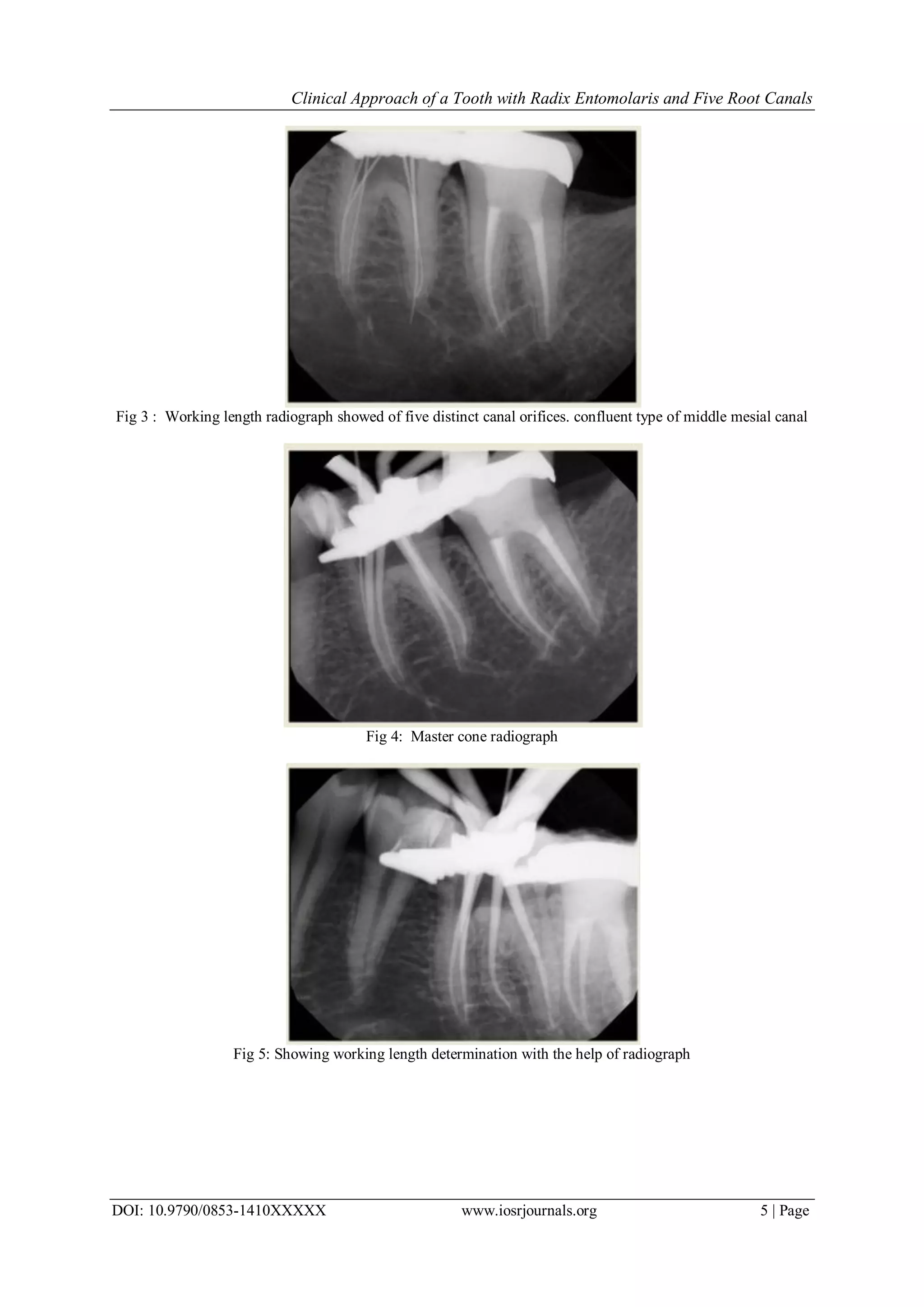 Clinical Approach of a Tooth with Radix Entomolaris and Five Root ...