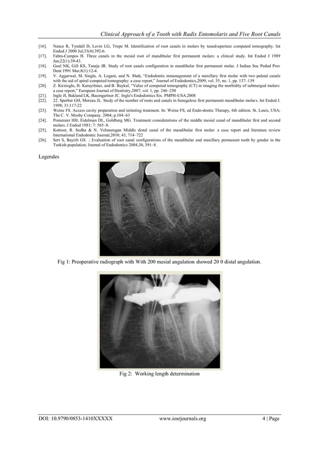 Clinical Approach of a Tooth with Radix Entomolaris and Five Root ...