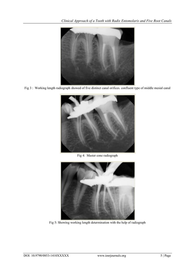 Clinical Approach of a Tooth with Radix Entomolaris and Five Root ...