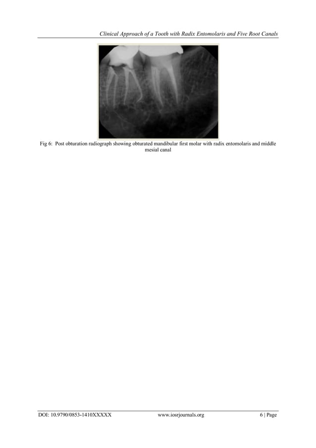 Clinical Approach of a Tooth with Radix Entomolaris and Five Root ...