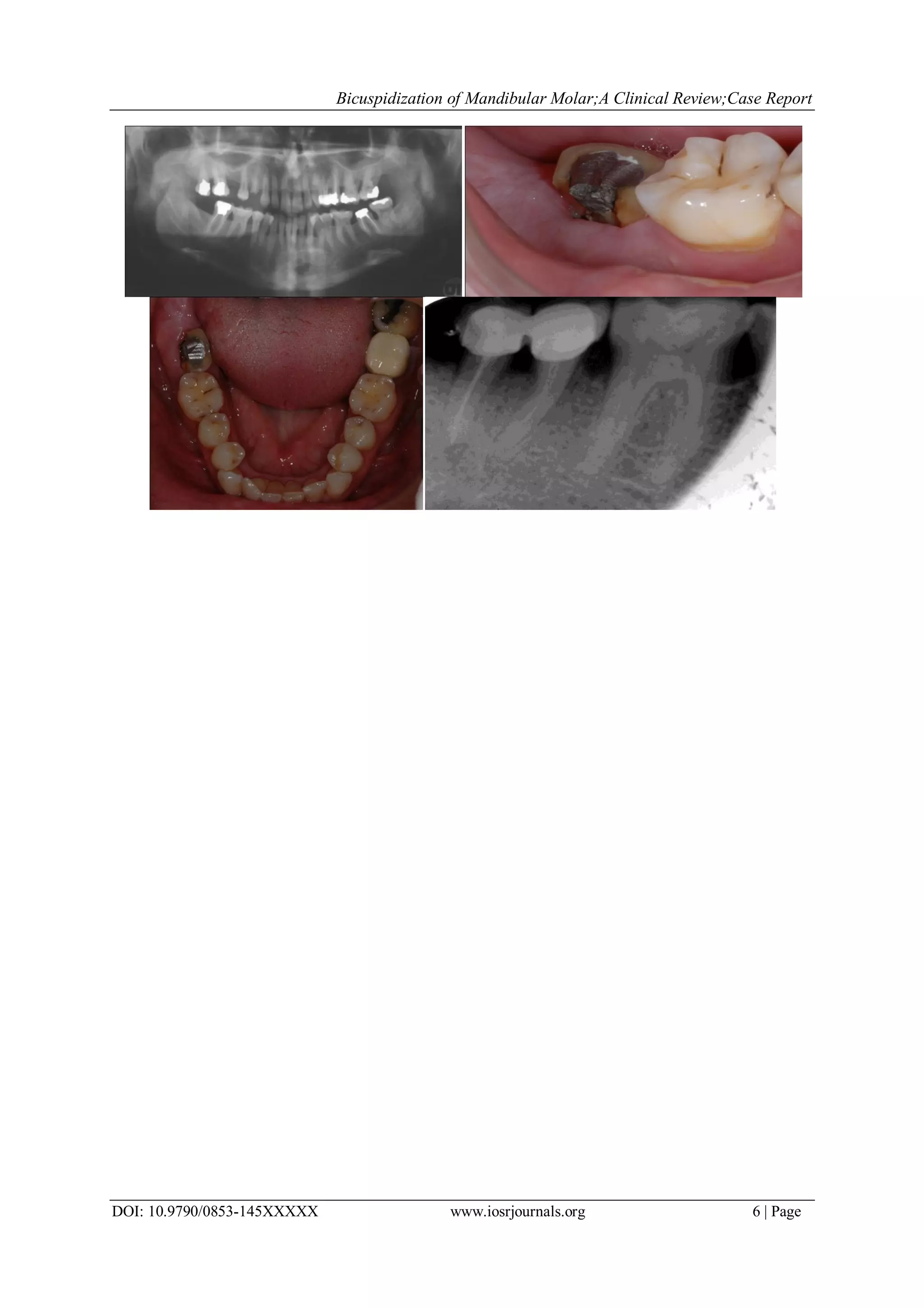 Bicuspidization of Mandibular Molar;A Clinical Review;Case Report | PDF