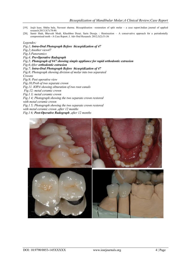 Bicuspidization of Mandibular Molar;A Clinical Review;Case Report | PDF
