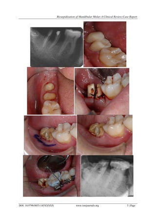 Bicuspidization of Mandibular Molar;A Clinical Review;Case Report | PDF