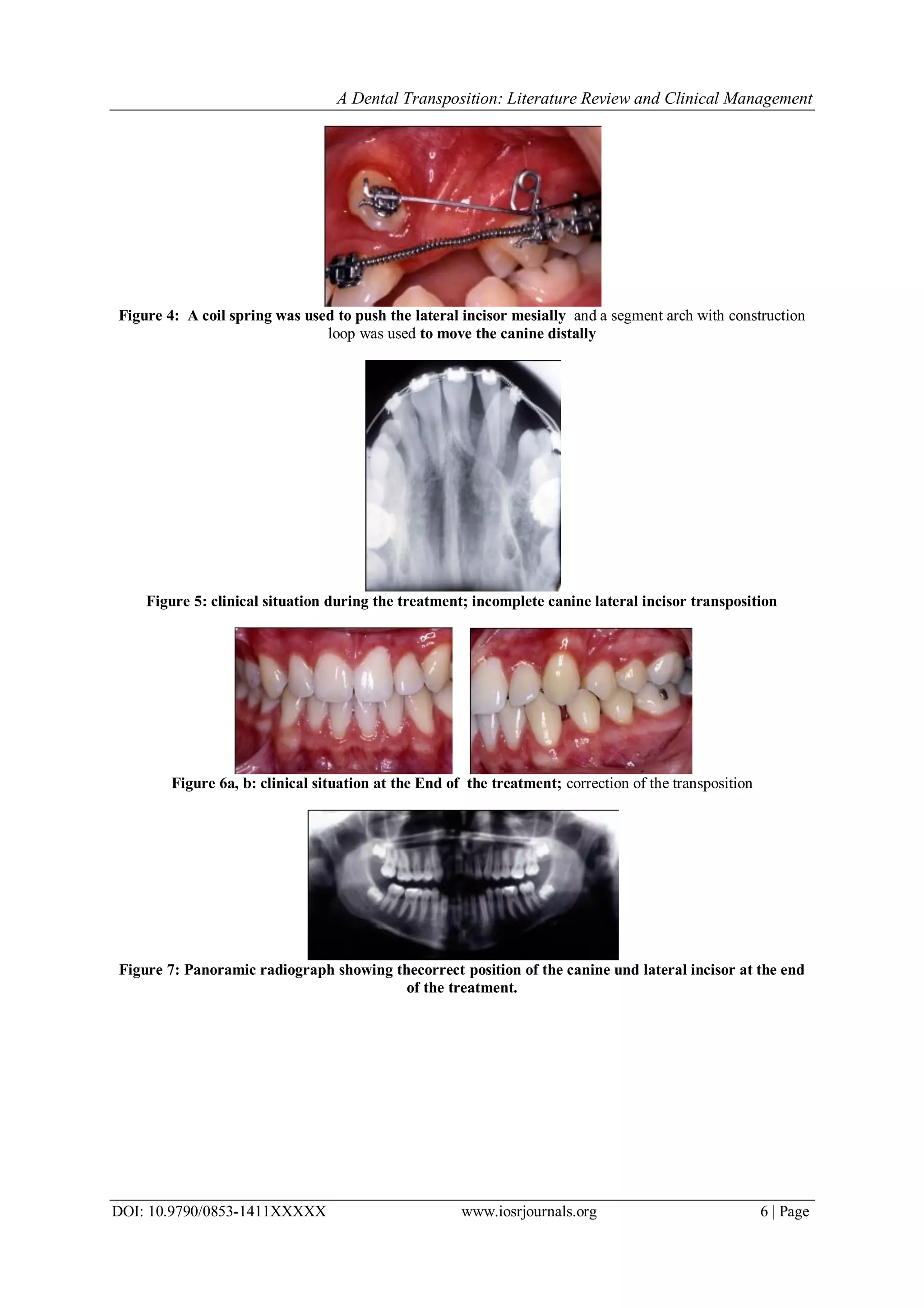 A Dental Transposition: Literature Review and Clinical Management | PDF