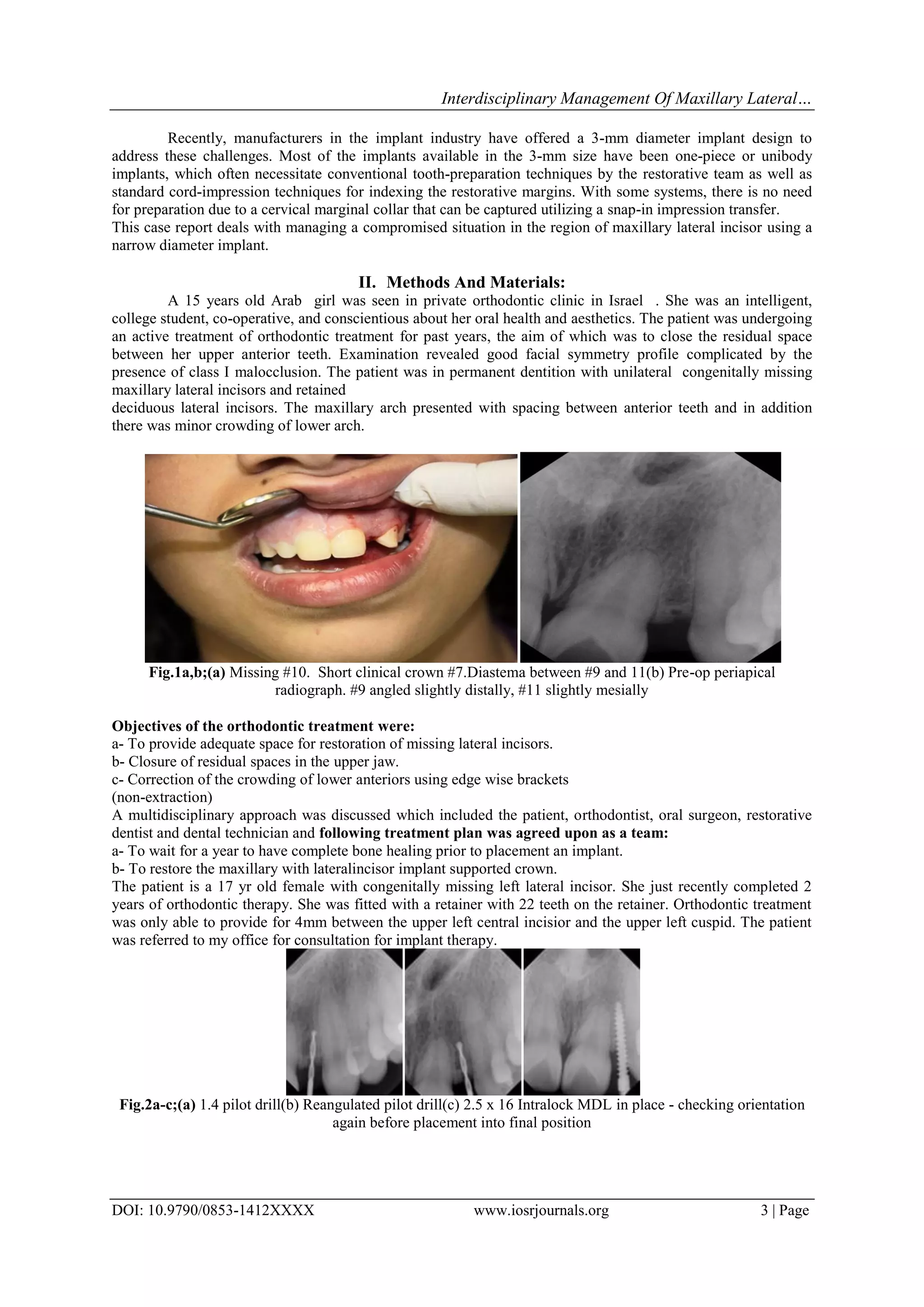 Interdisciplinary Management Of Maxillary Lateral Incisors Pdf