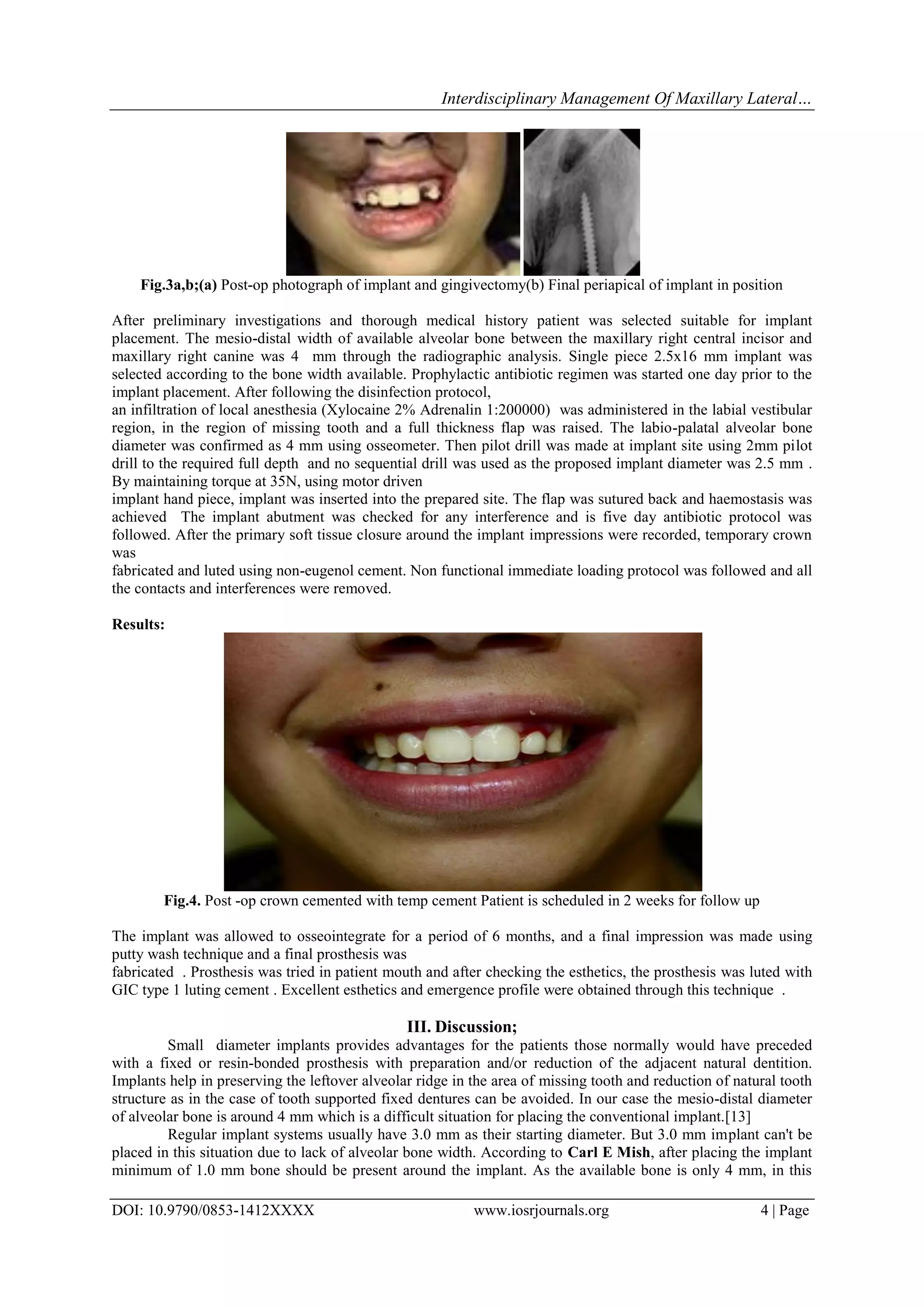 Interdisciplinary Management Of Maxillary Lateral Incisors Pdf