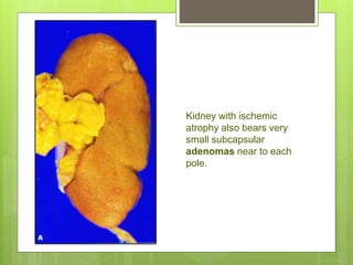 L6- Benign and Malignant Tumours of the Kidney.ppt