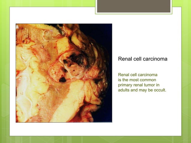 L6- Benign and Malignant Tumours of the Kidney.ppt