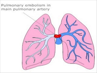 L6 pulmonary embolism | PDF