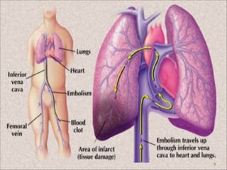 L6 pulmonary embolism | PDF