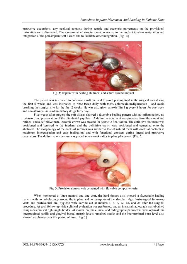 Immediate Implant Placement and Loading in Esthetic Zone | PDF