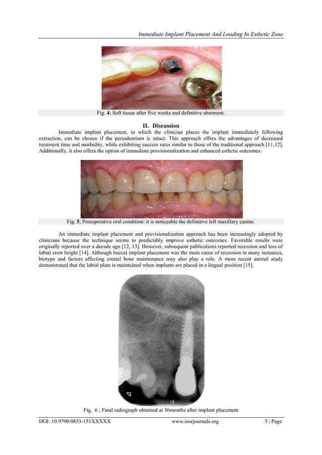Immediate Implant Placement and Loading in Esthetic Zone | PDF