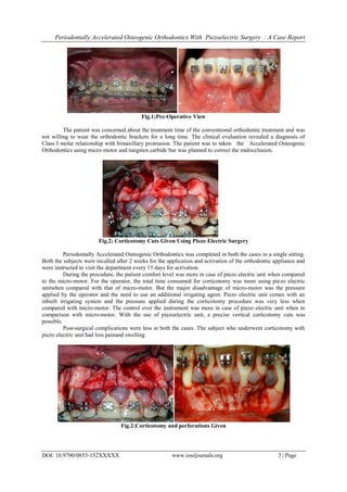 Periodontally Accelerated Osteogenic Orthodontics with Piezoelectric Surgery: A Case Report | PDF