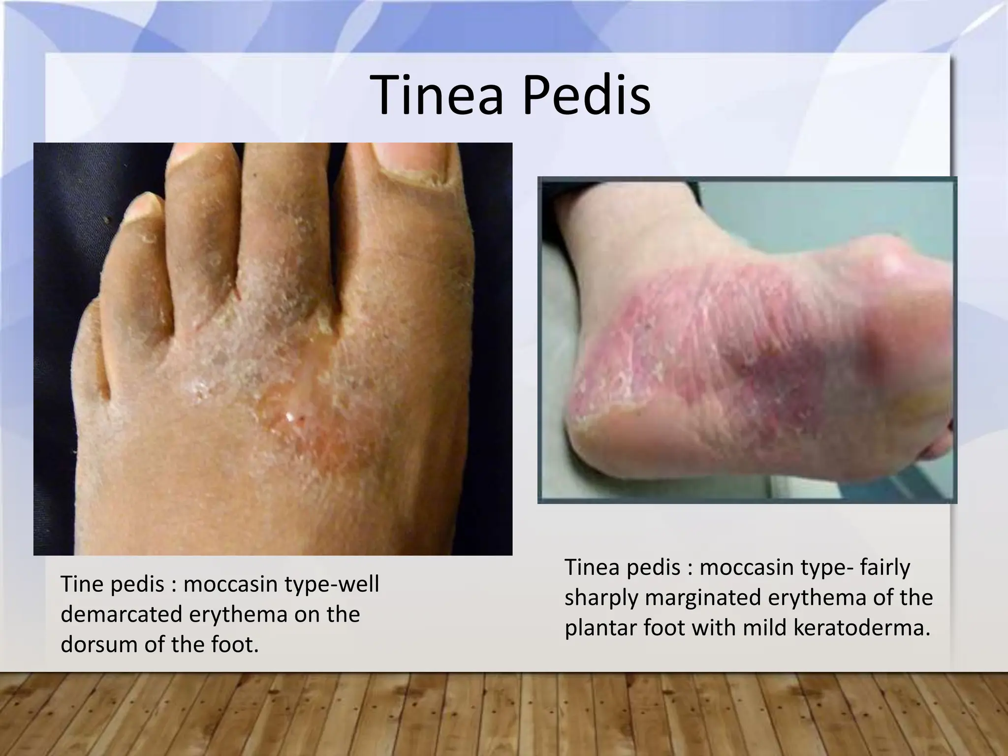 Common Fungal Infections of The Skin.ppt