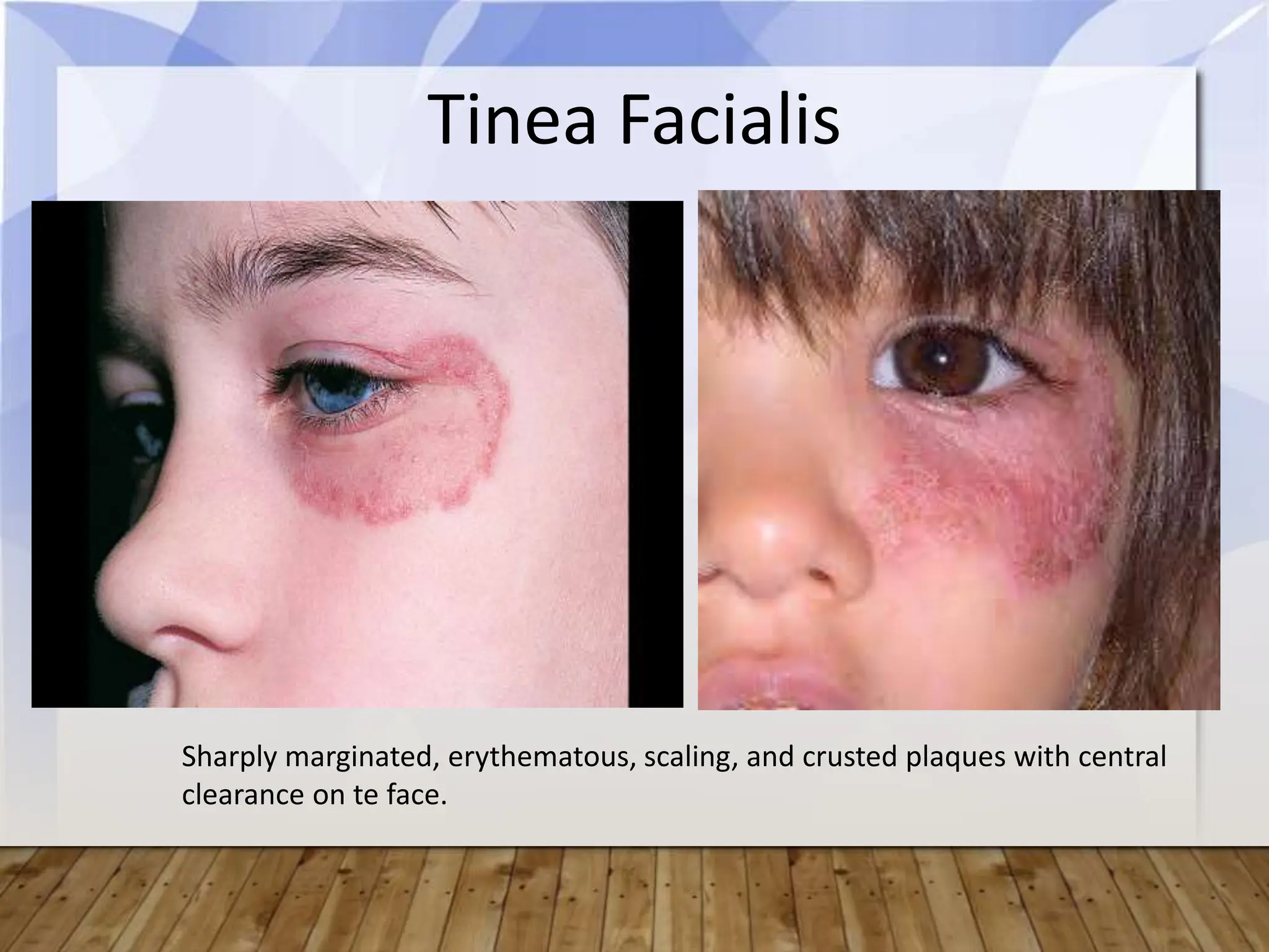 Common Fungal Infections of The Skin.ppt