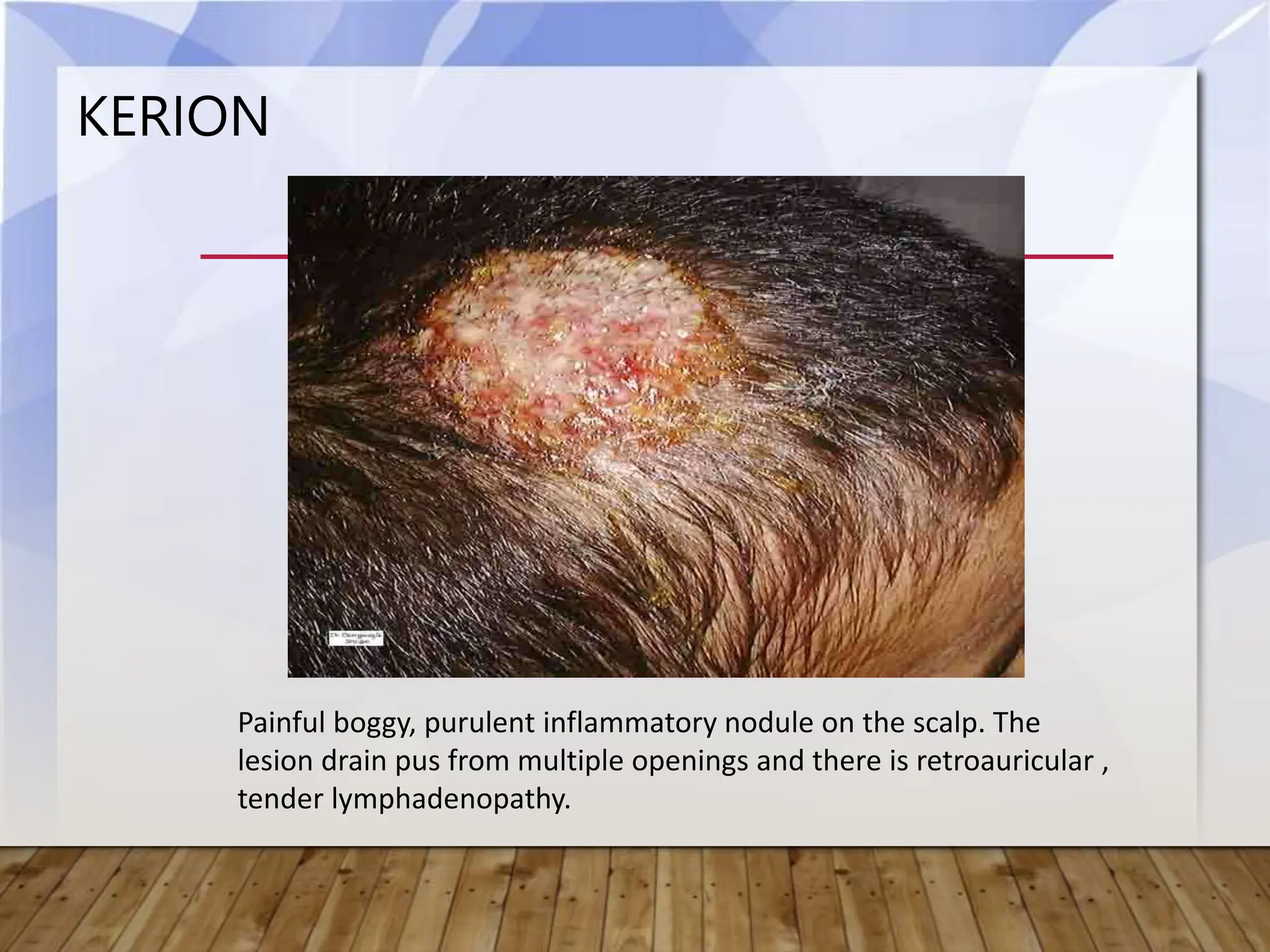 Common Fungal Infections of The Skin.ppt