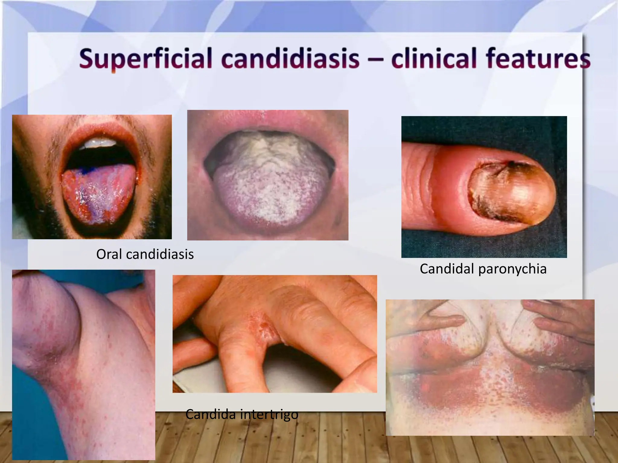 Common Fungal Infections of The Skin.ppt