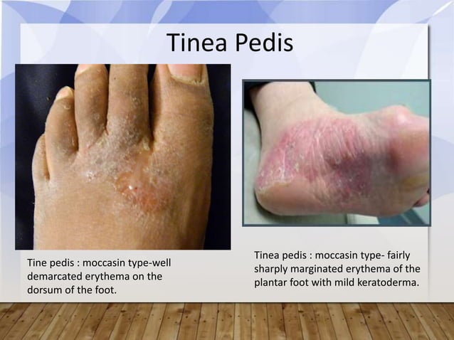 Common Fungal Infections of The Skin.ppt | Foot Health | Diseases and ...