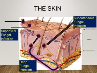 Common Fungal Infections of The Skin.ppt