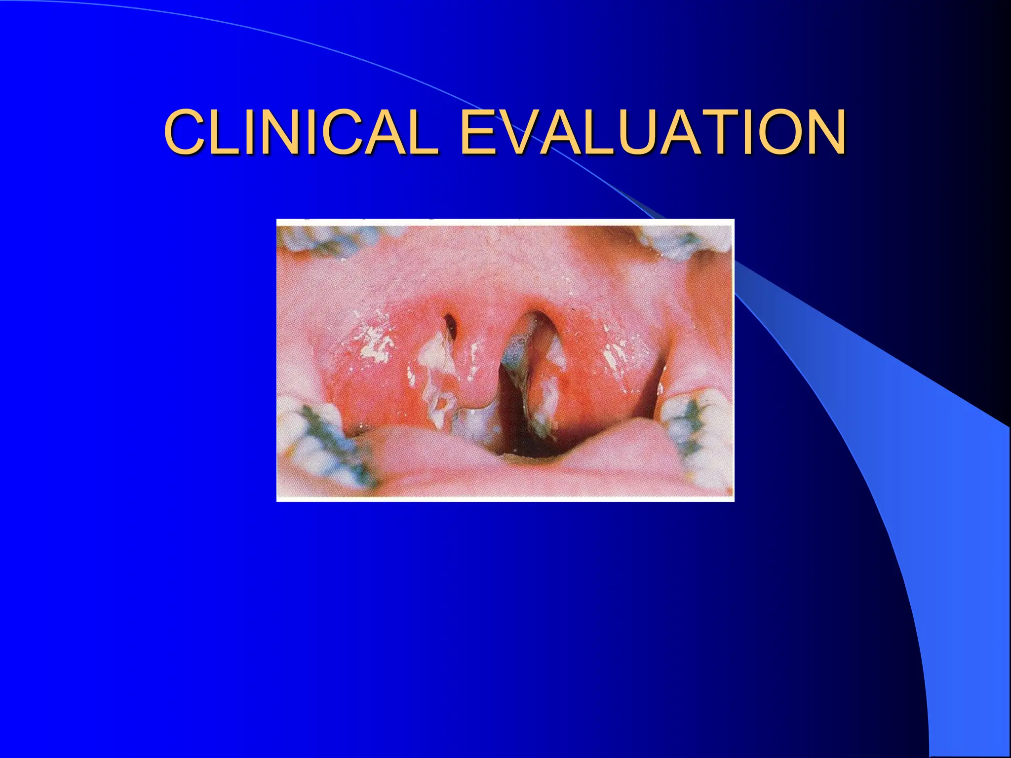 L6_TONSILLITIS.-ADENOIDS.-TONSILLAR-HYPERTROPHY-LECTURE.pdf