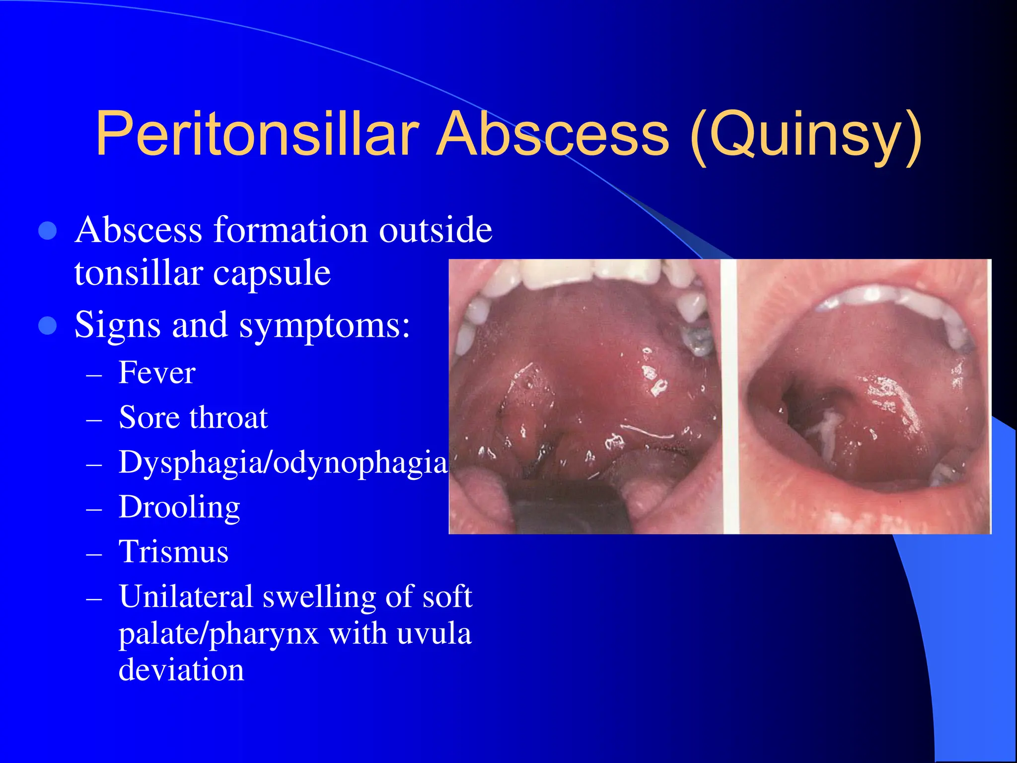 L6_TONSILLITIS.-ADENOIDS.-TONSILLAR-HYPERTROPHY-LECTURE.pdf