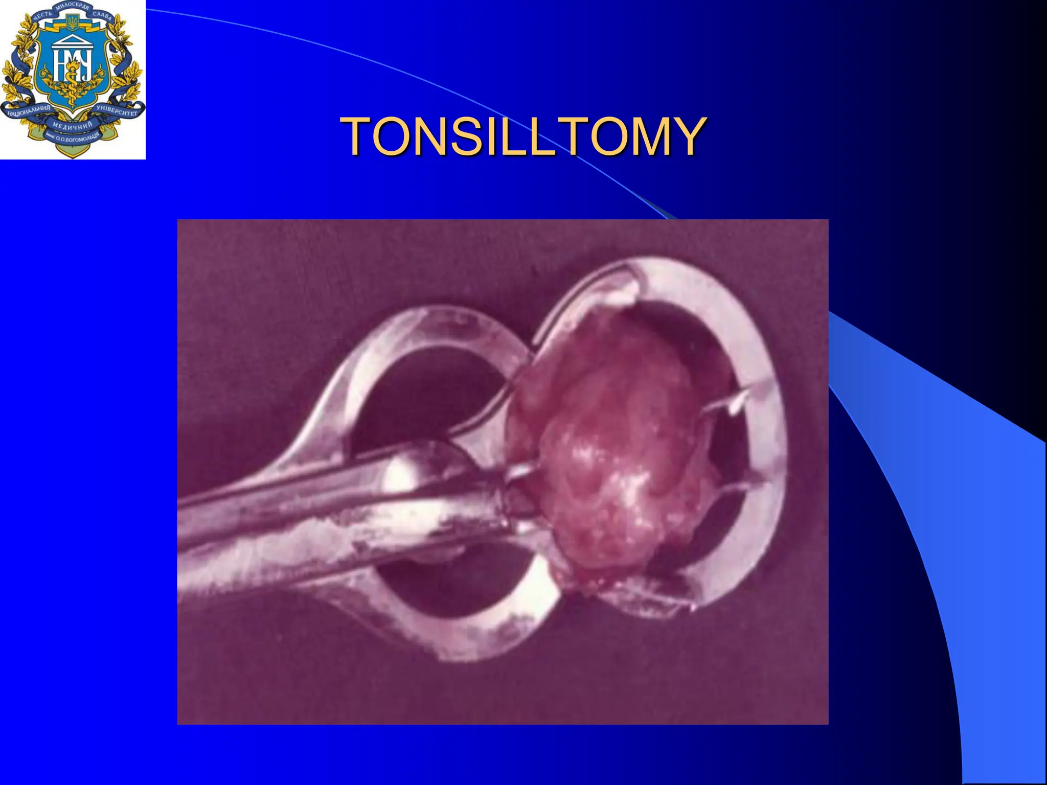 L6_TONSILLITIS.-ADENOIDS.-TONSILLAR-HYPERTROPHY-LECTURE.pdf