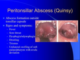 L6_TONSILLITIS.-ADENOIDS.-TONSILLAR-HYPERTROPHY-LECTURE.pdf