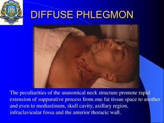 L6_TONSILLITIS.-ADENOIDS.-TONSILLAR-HYPERTROPHY-LECTURE.pdf