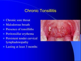 L6_TONSILLITIS.-ADENOIDS.-TONSILLAR-HYPERTROPHY-LECTURE.pdf