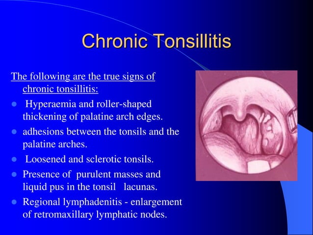 L6_TONSILLITIS.-ADENOIDS.-TONSILLAR-HYPERTROPHY-LECTURE.pdf