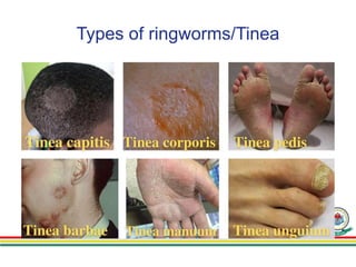 L8. Skin and soft tissue infections .pptx | Foot Health | Diseases and ...