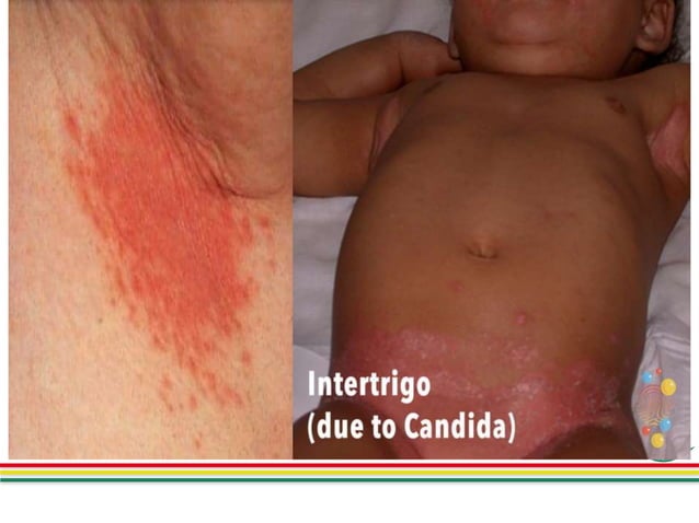 L8. Skin and soft tissue infections .pptx | Foot Health | Diseases and Conditions