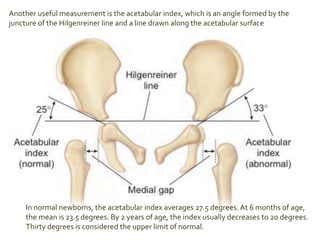Developmental Dysplasia of Hip Radiological findings | PPTX