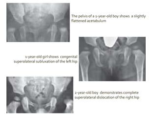 Developmental Dysplasia of Hip Radiological findings | PPTX