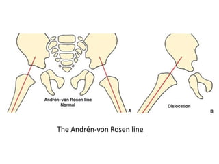 Developmental Dysplasia of Hip Radiological findings | PPTX