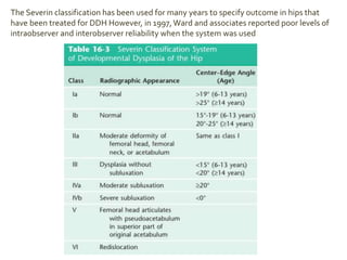 Developmental Dysplasia of Hip Radiological findings | PPTX