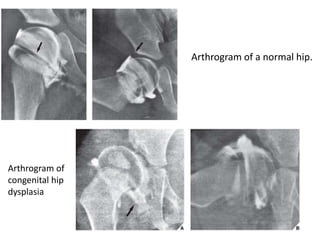 Developmental Dysplasia of Hip Radiological findings | PPT