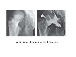Developmental Dysplasia of Hip Radiological findings | PPT