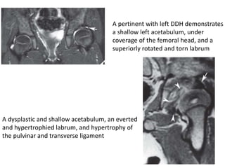 Developmental Dysplasia of Hip Radiological findings | PPTX