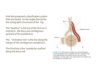 Developmental Dysplasia of Hip Radiological findings | PPTX