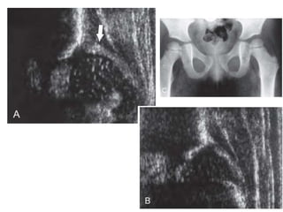 Developmental Dysplasia of Hip Radiological findings | PPTX