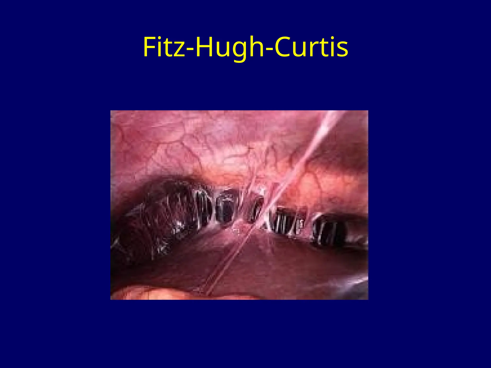 Pelvic Inflammatory Disease (PID) is infection or inflammation in upper ...