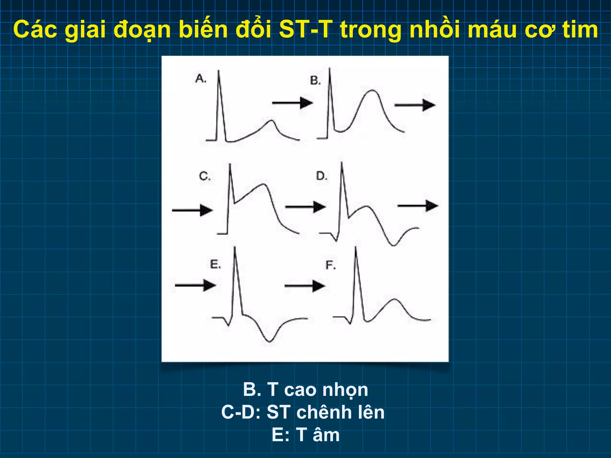 ECG THIẾU MÁU CƠ TIM | PDF
