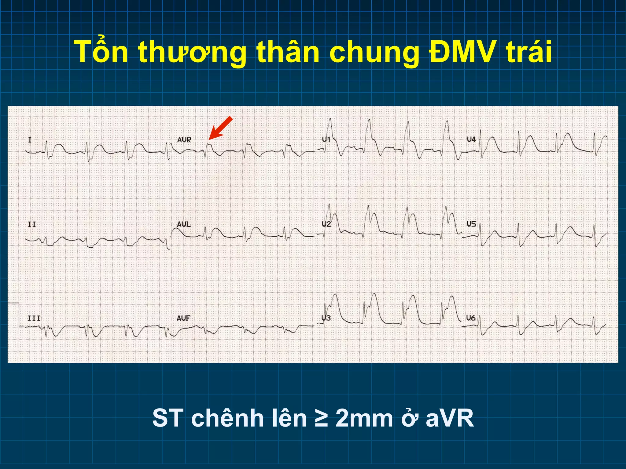 ECG THIẾU MÁU CƠ TIM | PDF