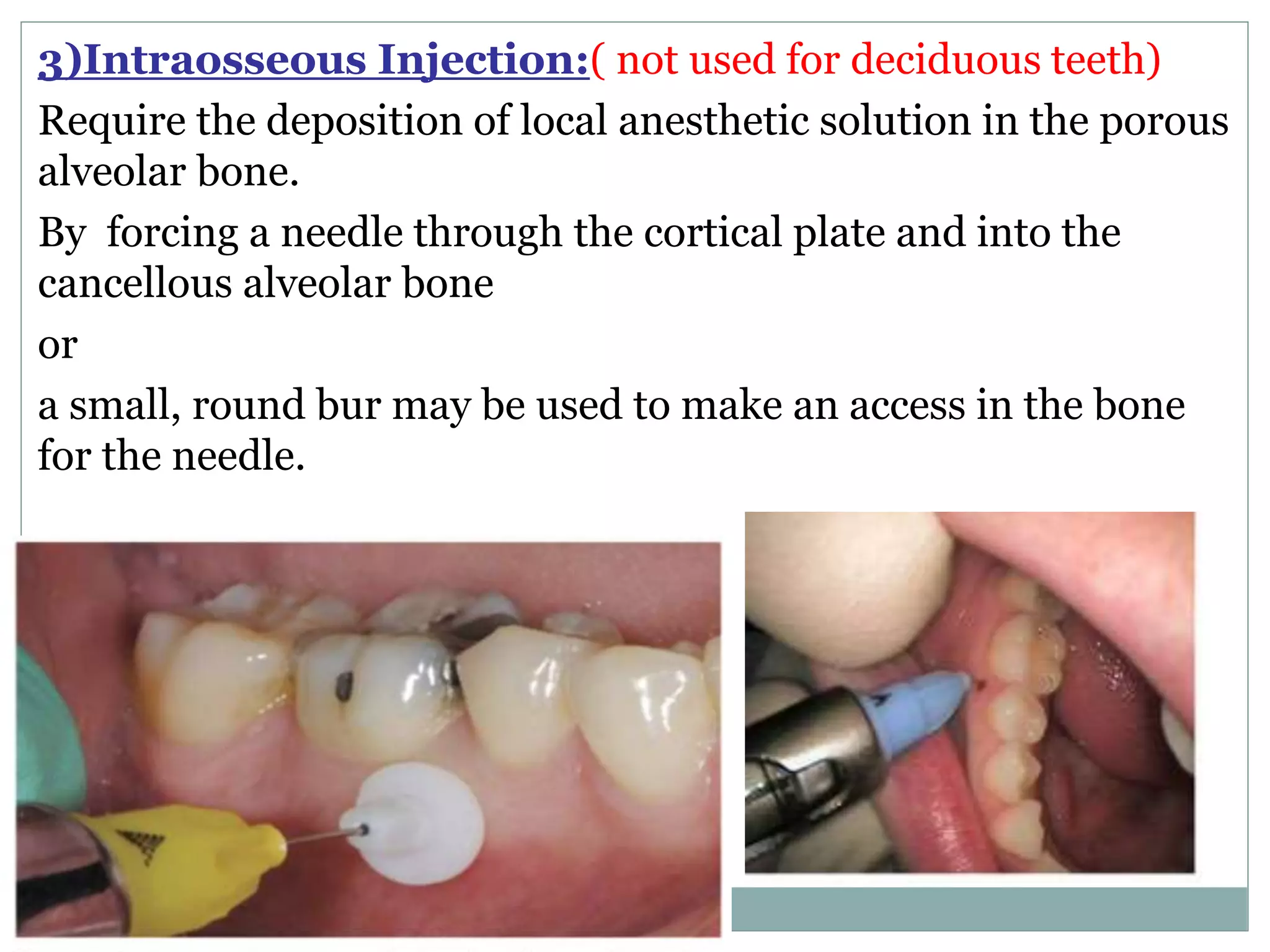 Local Anesthesia for pediatric dentistry | PPTX