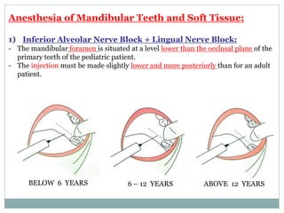 Inferior Alveolar Nerve Block In Children