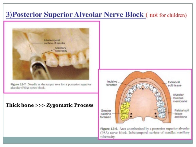 Reference 467 Posterior Superior Alveolar Nerve Block - vrogue.co