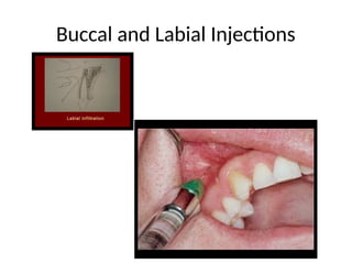 Local anesthesia in dentistry and types.pptx